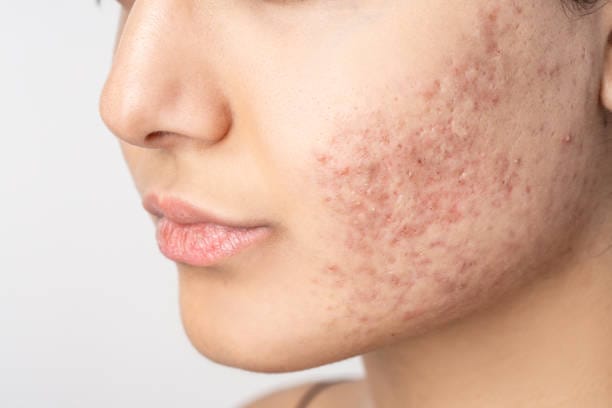 6 Common Skin Conditions And How To Deal With Them | GlamCityz
